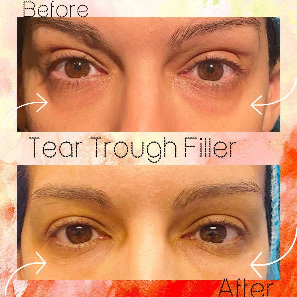 Pittsburgh PA and West Palm Beach FL Filler Treatments: XeominFillers ...