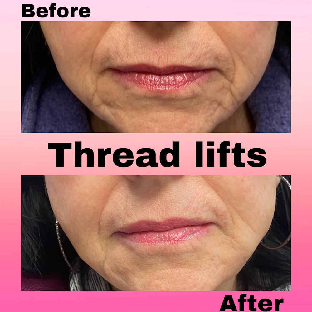 PDO Thread Lifts Luna Vision and Med Spa | Pittsburgh, Greensburg ...